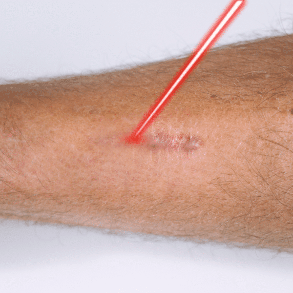 Laser Scar Treatment for Acne & Surgical Scarring in Bradenton FL ...